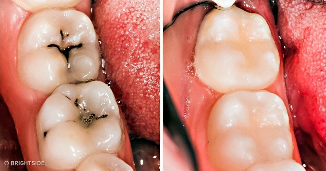 5 easy steps to heal cavities and fight tooth decay | Grandma's Things