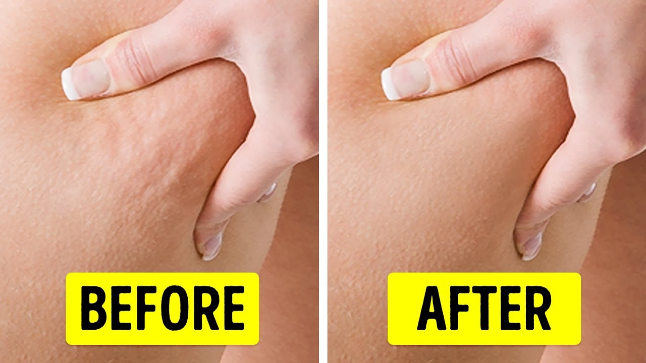 Want To Get Rid Of Cellulite These Tips Will Help Grandma s Things Want To Get Rid Of Cellulite These Tips Will Help Grandma s Things