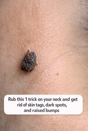 Rub this 1 trick on your neck and get rid of skin tags, dark spots, and ...