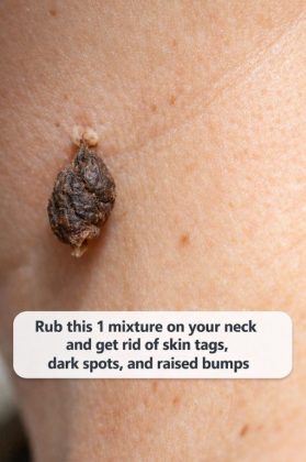 Rub this 1 mixture on your neck and get rid of skin tags, dark spots ...